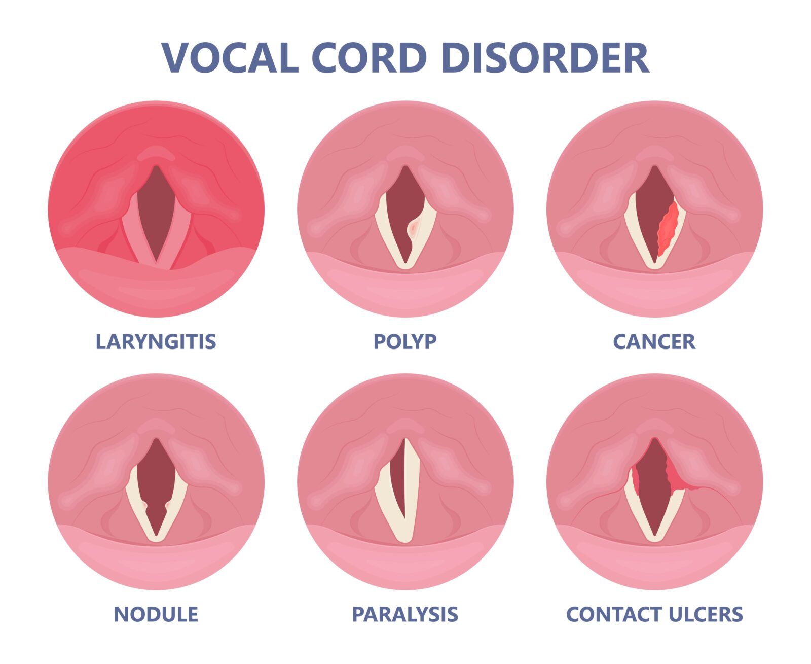Understanding Vocal Cord Dysfunction: Laryngoscopy vs. Videostroboscopy ...